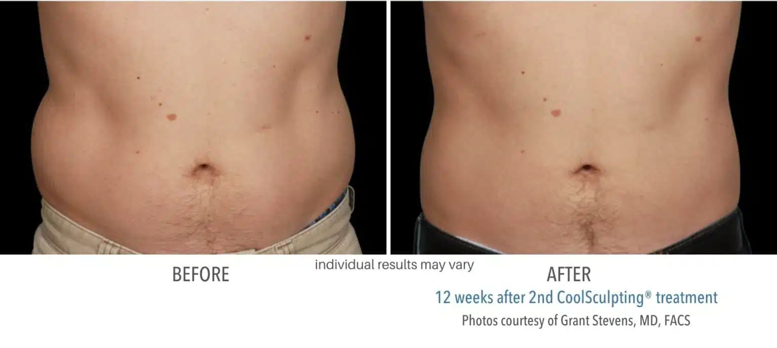 Cold Sculpting | CoolSculpting in Newtown Square