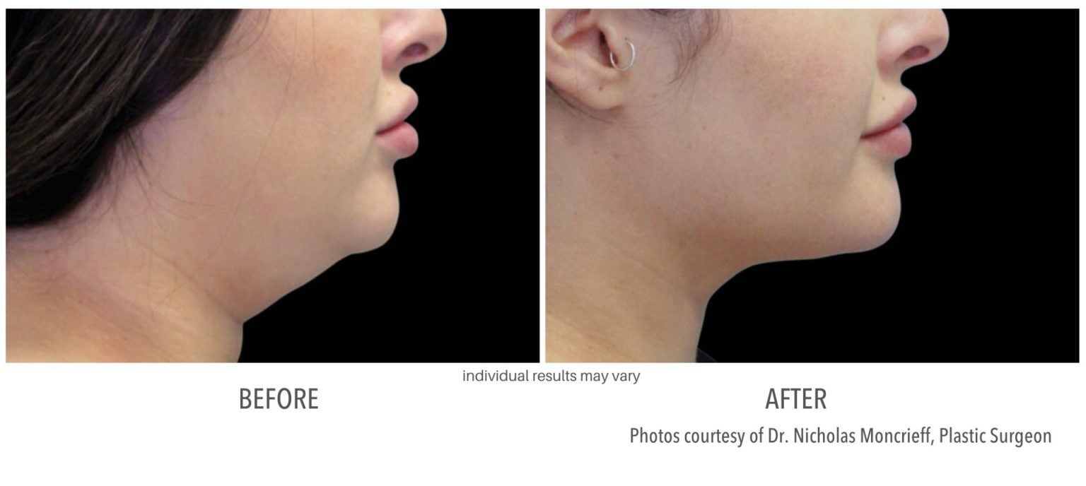 Philadelphia CoolSculpting®: Non-Invasive Body Sculpting