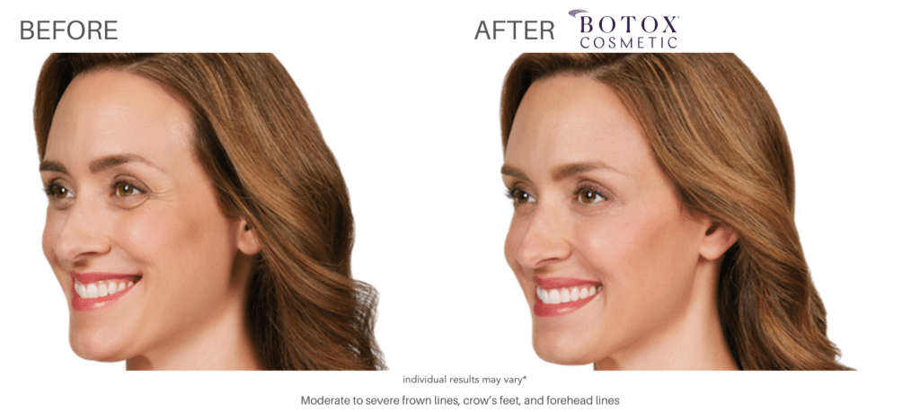 Botox Philly | Best Philadelphia Botox