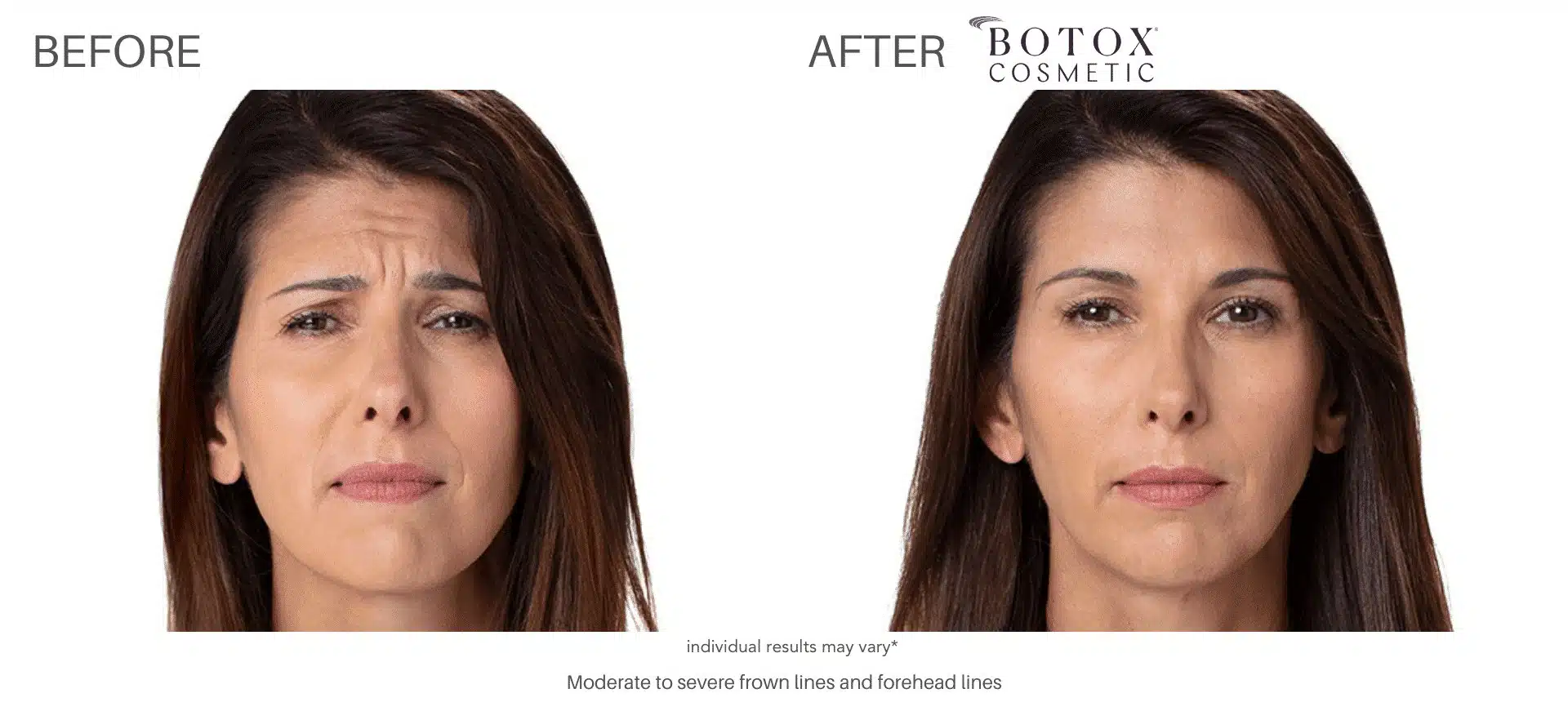 Botox Philly | Best Philadelphia Botox