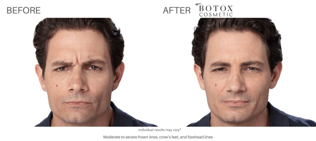 Botox Philly | Best Philadelphia Botox