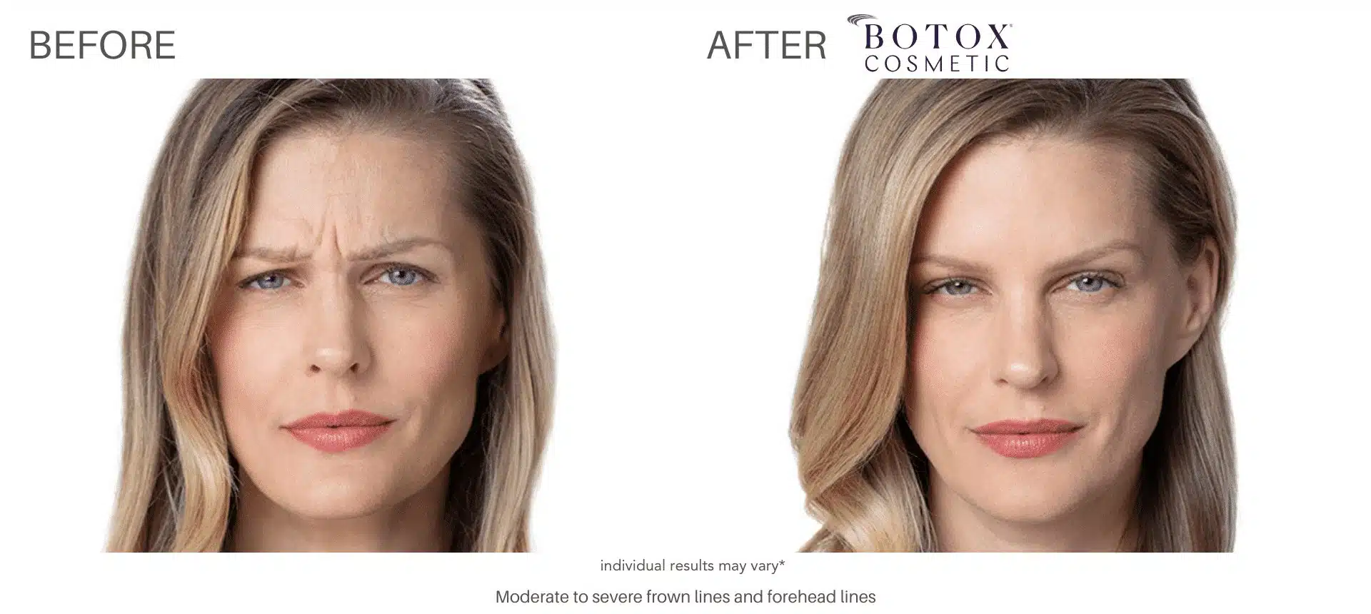 Botox Philly | Best Philadelphia Botox