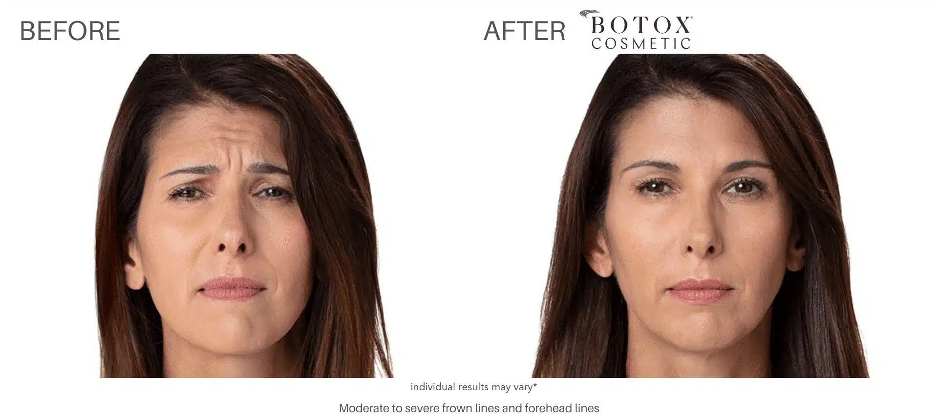 Botox Nose Slimming/Bunny Nose Botox