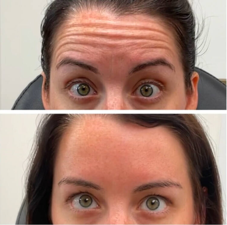 Botox Philly | Best Philadelphia Botox