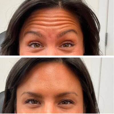 Botox Philly | Best Philadelphia Botox