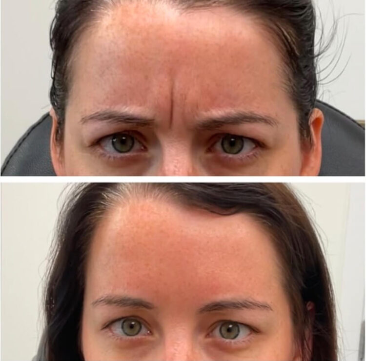 Botox Philly | Best Philadelphia Botox